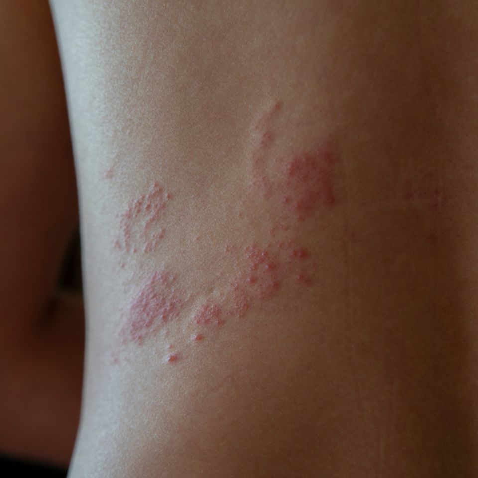 Gürtelrose-Warnzeichen: 6 häufige Symptome | BRIGITTE.de
