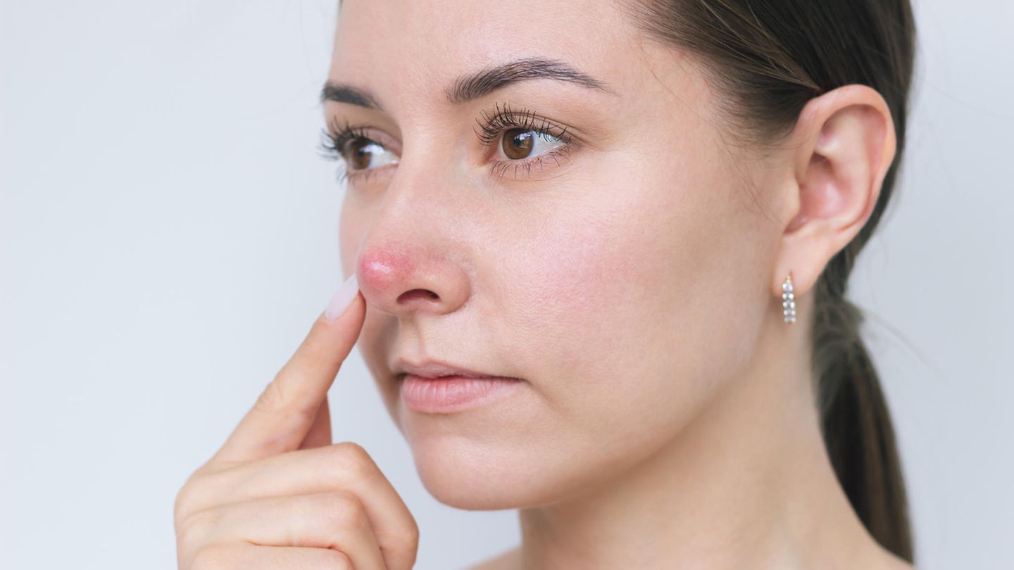 Rote Nase: So kaschierst du sie ganz schnell | BRIGITTE.de